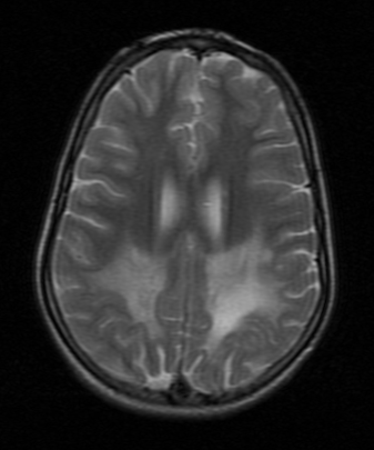 ADRENOLEUKODYSTROPHY-MRI - Sumer's Radiology Blog
