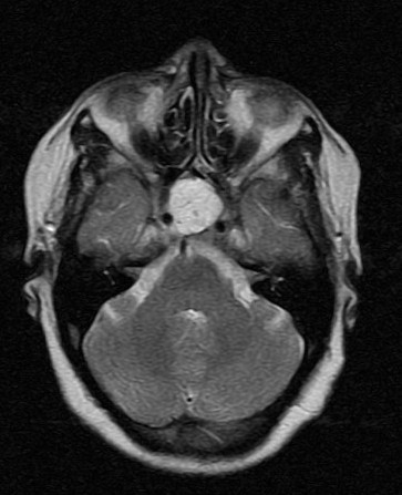 Empty Sella and CSF Rhinorrhea-MRI & CT - Sumer's Radiology Blog