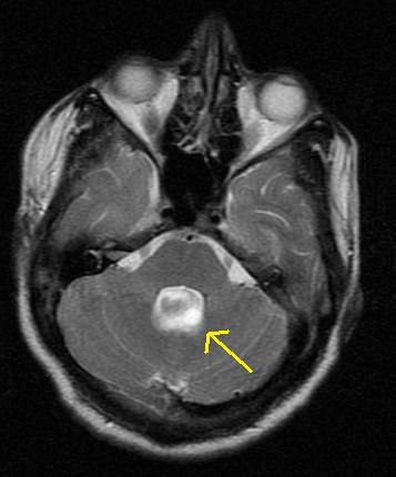 Intraventricular Cysticercosis-MRI - Sumer's Radiology Blog