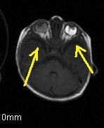 Persistent Hyperplastic Primary Vitreous-MRI - Sumer's Radiology Blog