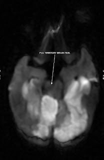 Basilar Artery Dissection-MRI - Sumer's Radiology Blog
