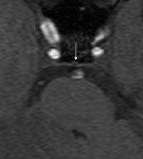 Basilar Artery Dissection-MRI - Sumer's Radiology Blog