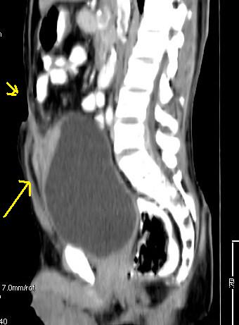 Urachal Carcinoma-CT - Sumer's Radiology Blog