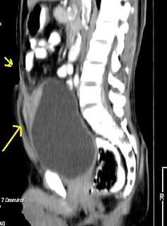Urachal Carcinoma-CT - Sumer's Radiology Blog