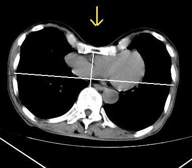 Funnel chest (pectus excavatum)-CT - Sumer's Radiology Blog