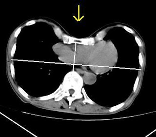 Funnel chest (pectus excavatum)-CT - Sumer's Radiology Blog