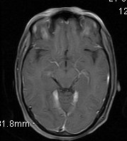 Hypertrophic cranial pachymeningitis-MRI - Sumer's Radiology Blog