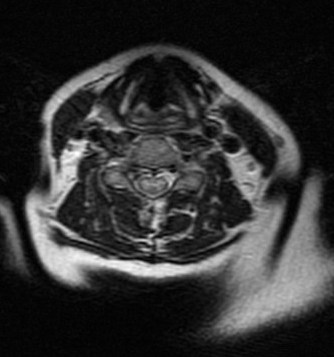 Anterior Spinal Cord Infarction-MRI - Sumer's Radiology Blog