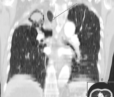 Air Mensicus Sign in Hydatid Disease - Sumer's Radiology Blog