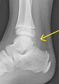 Os Trigonum - Sumer's Radiology Blog