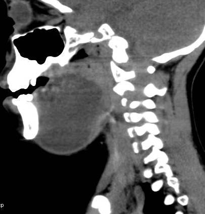 Ranula-CT images - Sumer's Radiology Blog