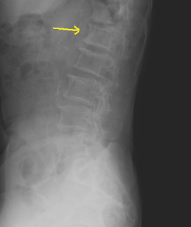 Paget's Disease of Bone - Sumer's Radiology Blog