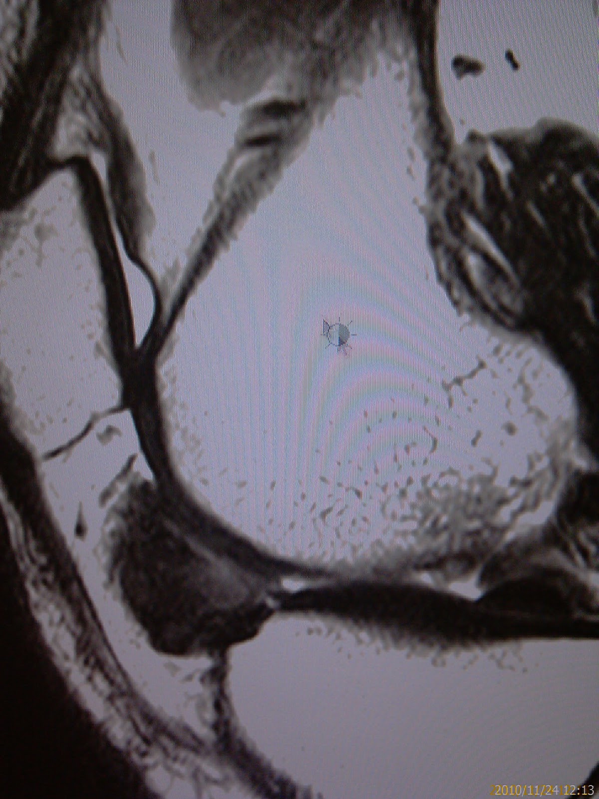 Pigmented Villonodular Synovitis