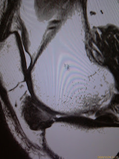 Pigmented Villonodular synovitis (PVNS) - Sumer's Radiology Blog