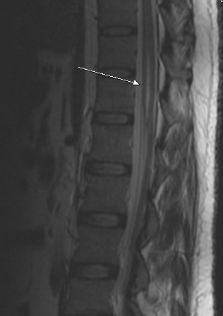 Post Spinal Anesthesia Syrinx-MRI - Sumer's Radiology Blog