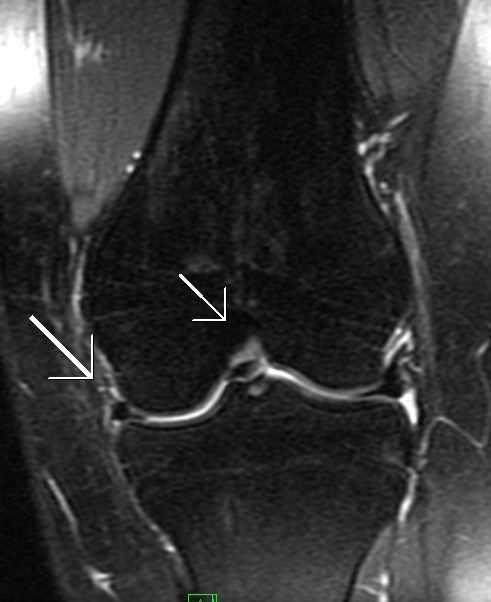 Bucket Handle Meniscal Tear-MRI - Sumer's Radiology Blog