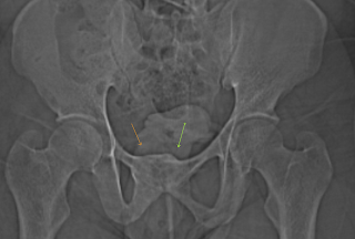 Symphysis Pubis Fusion - Sumer's Radiology Blog