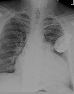 Cardiac Pacemaker for a General Radiologist - Sumer's Radiology Blog