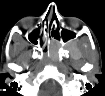 Juvenile angiofibroma-CT - Sumer's Radiology Blog