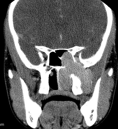 Juvenile angiofibroma-CT - Sumer's Radiology Blog