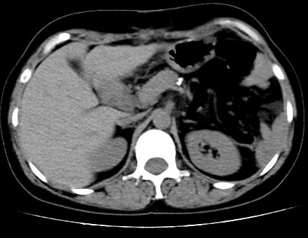 Holoprosencephaly: Omental Fat Necrosis