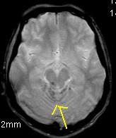 Chronic Trauma with Diffuse Axonal Injury-MRI - Sumer's Radiology Blog