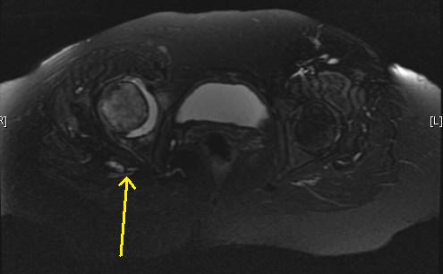 Rheumatoid Arthritis- Hip - Sumer's Radiology Blog