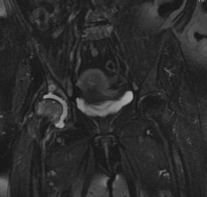 Rheumatoid Arthritis- Hip - Sumer's Radiology Blog