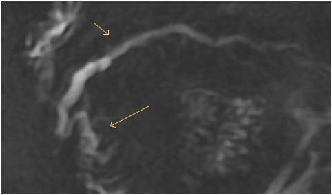 Pancreatic Divisum-MRCP - Sumer's Radiology Blog
