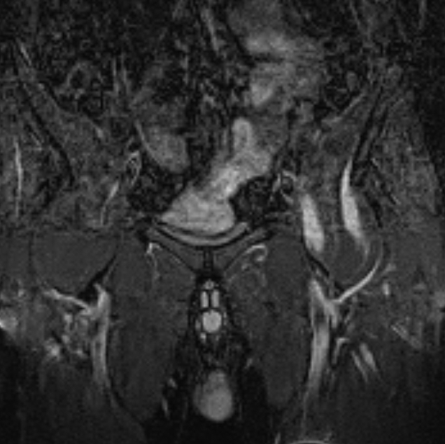 Iliopsoas Bursitis/ Tenditis-MRI - Sumer's Radiology Blog