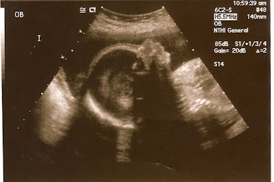 Pregnancy after Preemie: 24 Weeks 5 Days!!!