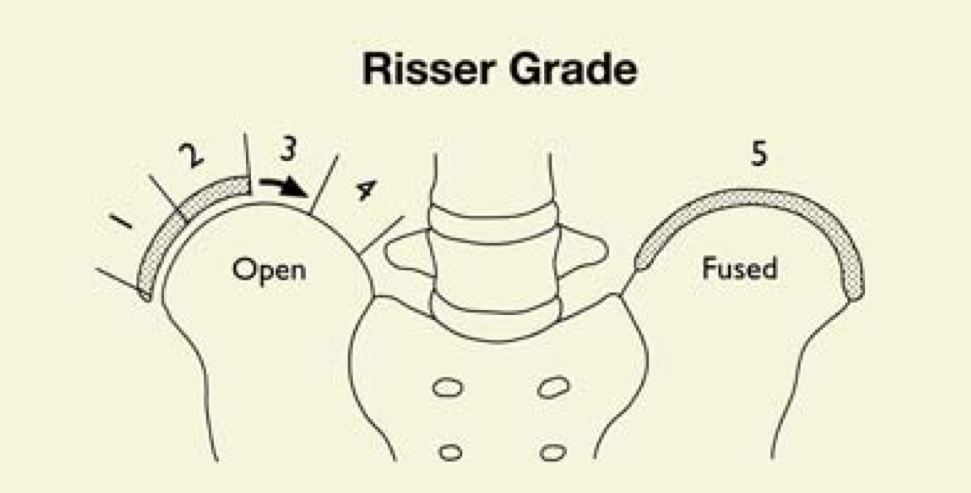 Utah Pediatric Radiology: Risser Classification