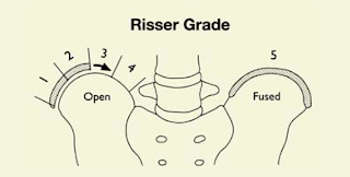 Utah Pediatric Radiology: Risser Classification