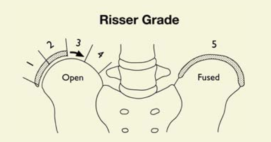 Utah Pediatric Radiology: Risser Classification