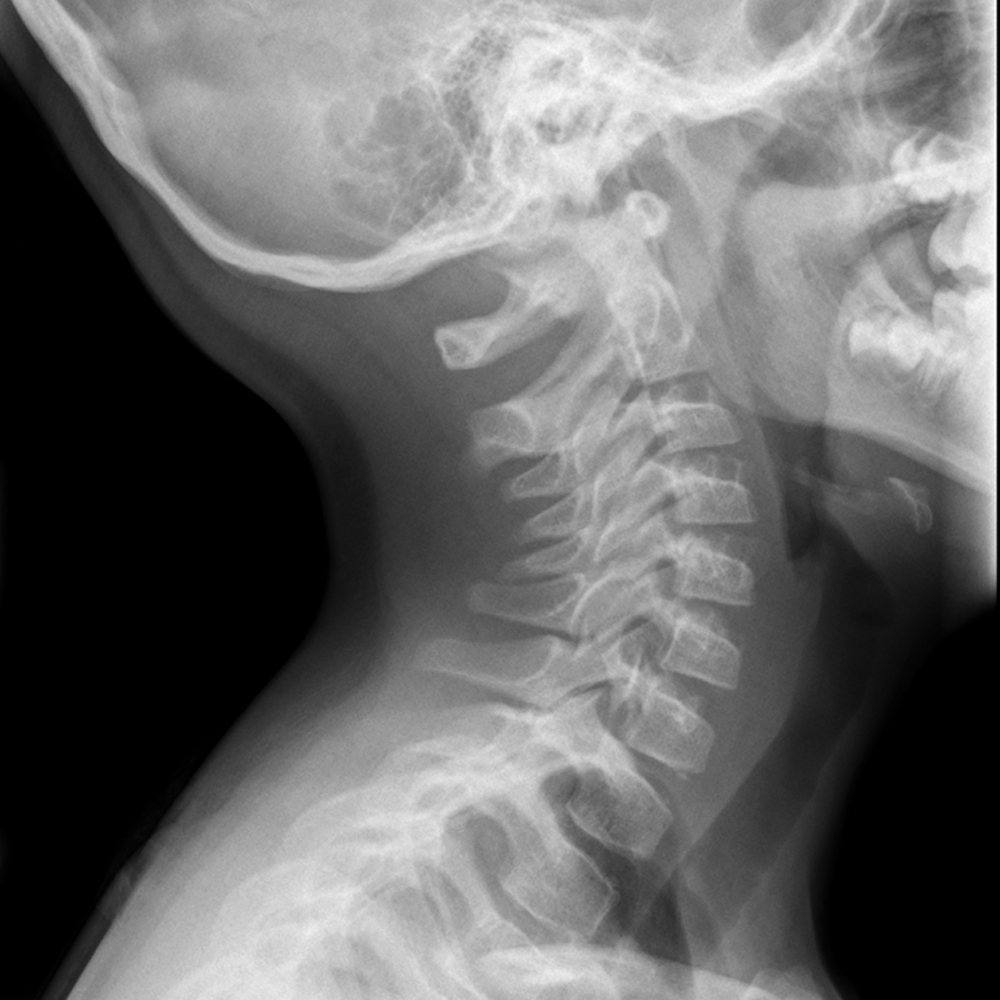 Utah Pediatric Radiology: Case of the Week: Hard left supraclavicular mass