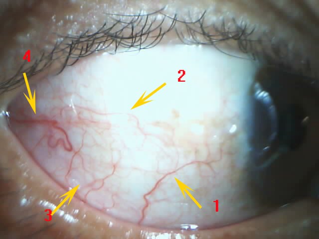 Modern & Multidimensional Iridology: Sclerology Analysis - 29