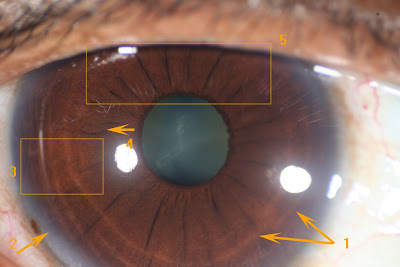 Modern & Multidimensional Iridology: Iridology Analysis - 39