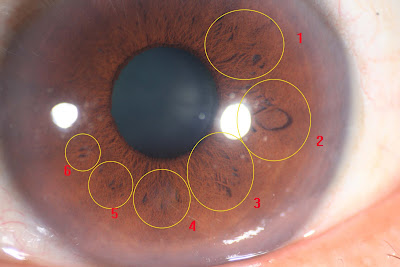 Modern & Multidimensional Iridology: Iridology Analysis- 10