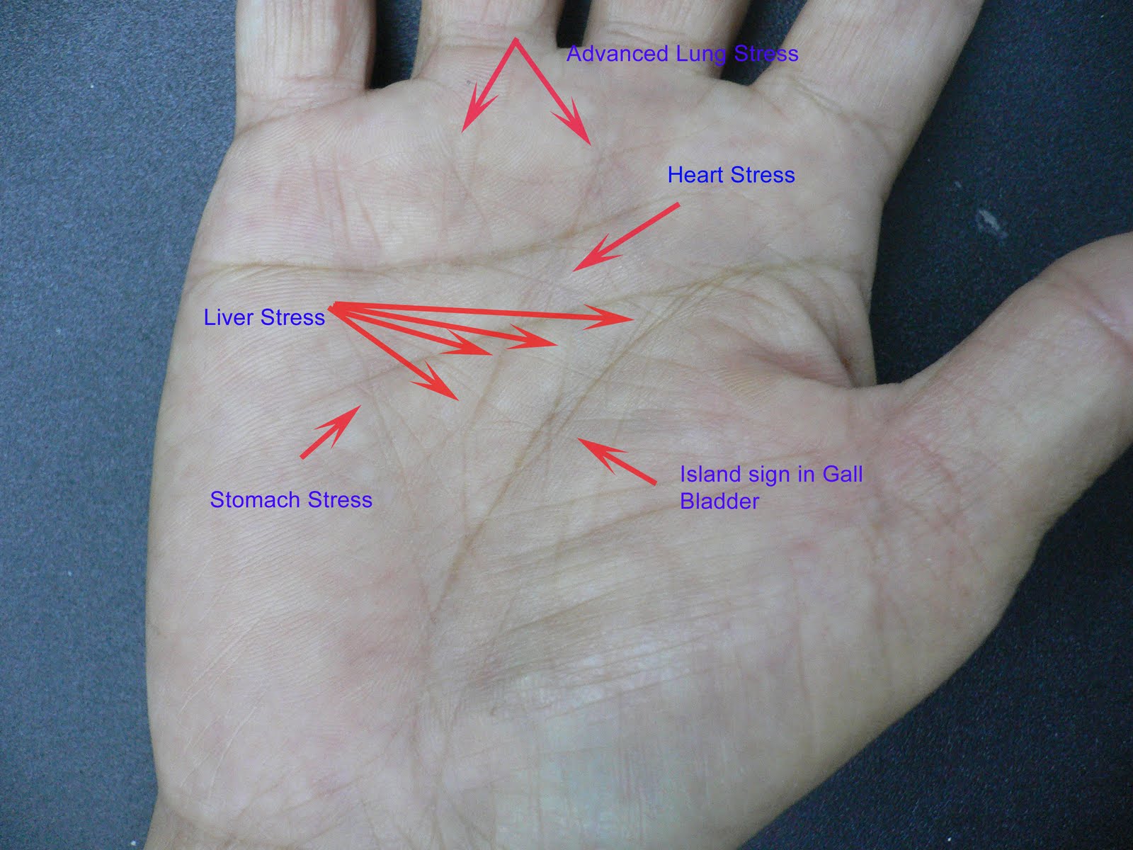 Modern & Multidimensional Iridology: Medical Palmistry Analysis