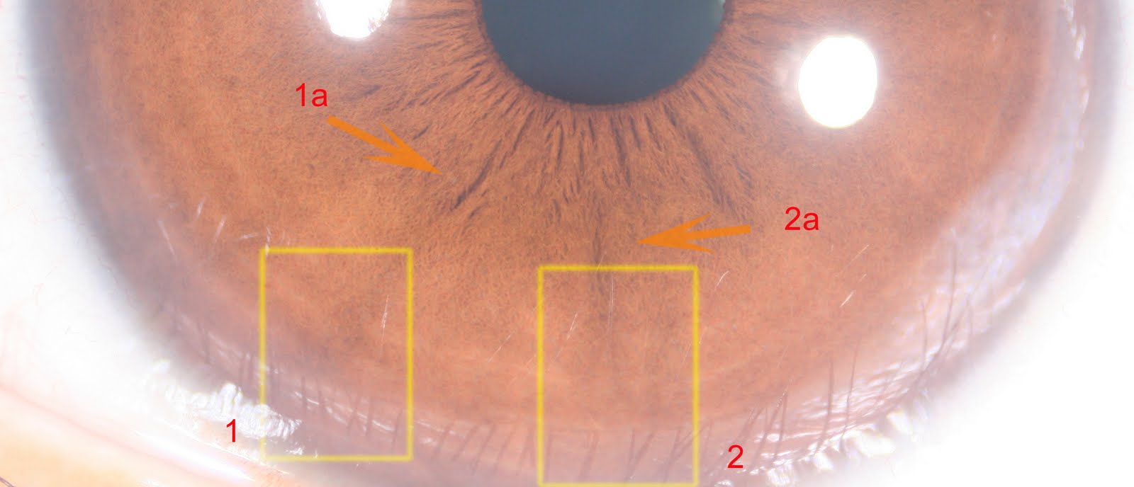 Modern & Multidimensional Iridology: Contraction Furrows