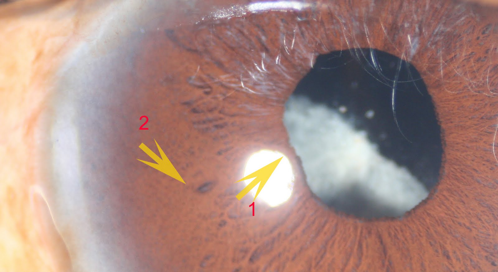 Modern & Multidimensional Iridology: Pupil Tonus