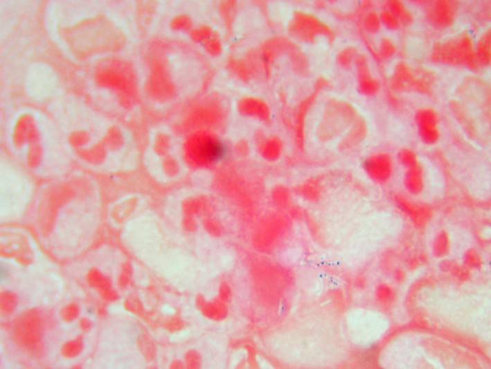 Fun With Microbiology (What's Buggin' You?): Mycobacterium tuberculosis ...