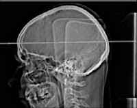 Aplikasi Klinik Multi Slice CT Scan: Pemeriksaan Neuro Perfusion