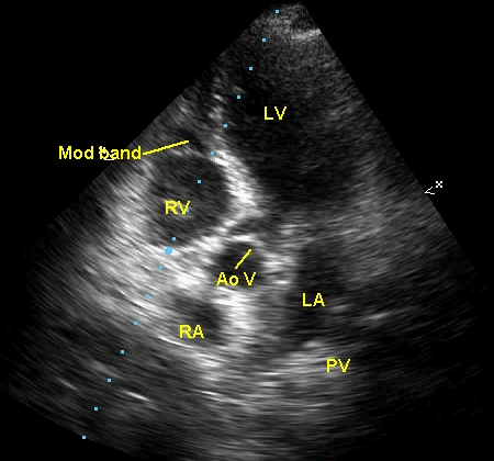 Cardiology Blog: Echocardiography Imaging Windows - The Apical 5 ...