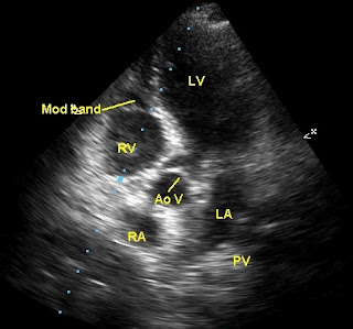 Cardiology Blog: Echocardiography Imaging Windows - The Apical 5 ...