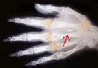 EndOfAmerica: Mark of the BEAST 666!!! (RFID CHIP)