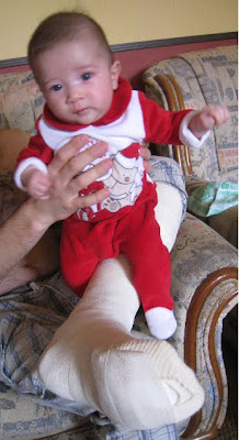 A Malaysian in France: Baby and leg cast