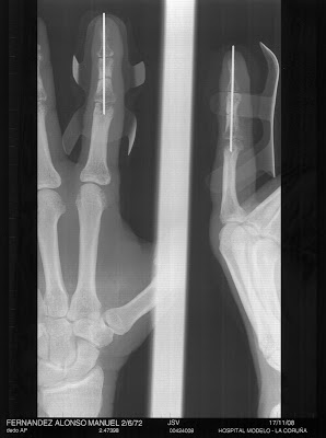 el blog de mafeal: DEDO ÍNDICE ROTO