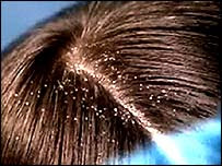 Medical World: Dandruff (Seborrhea)