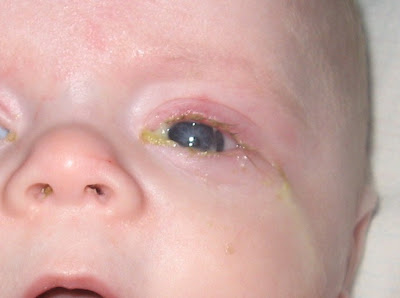 The Hatch Family: Booger Eyes